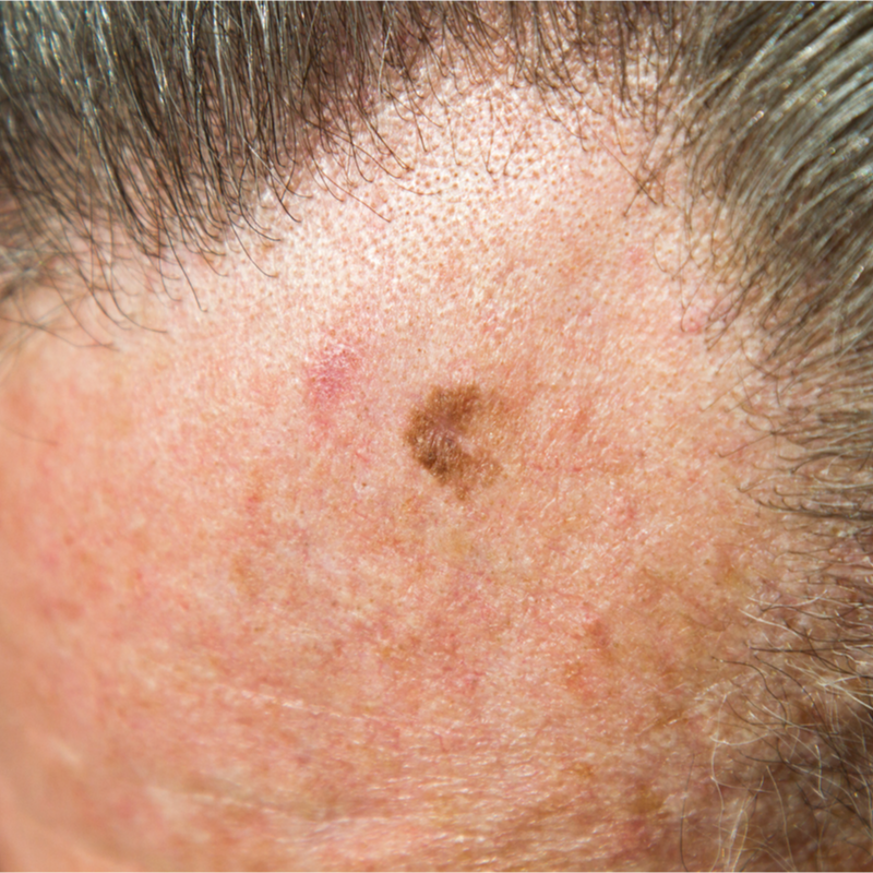 Lentigo maligno | frequenz-therapie.com